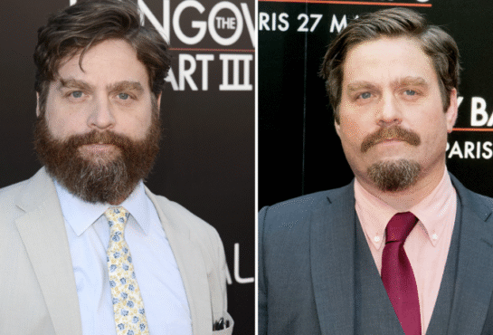 How They Looked: Famous Bald Celebs Before Going Bald
